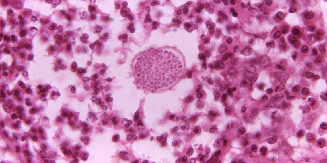 Valley Fever: NIH Funds Coccidioidomycosis Collaborative Research ...